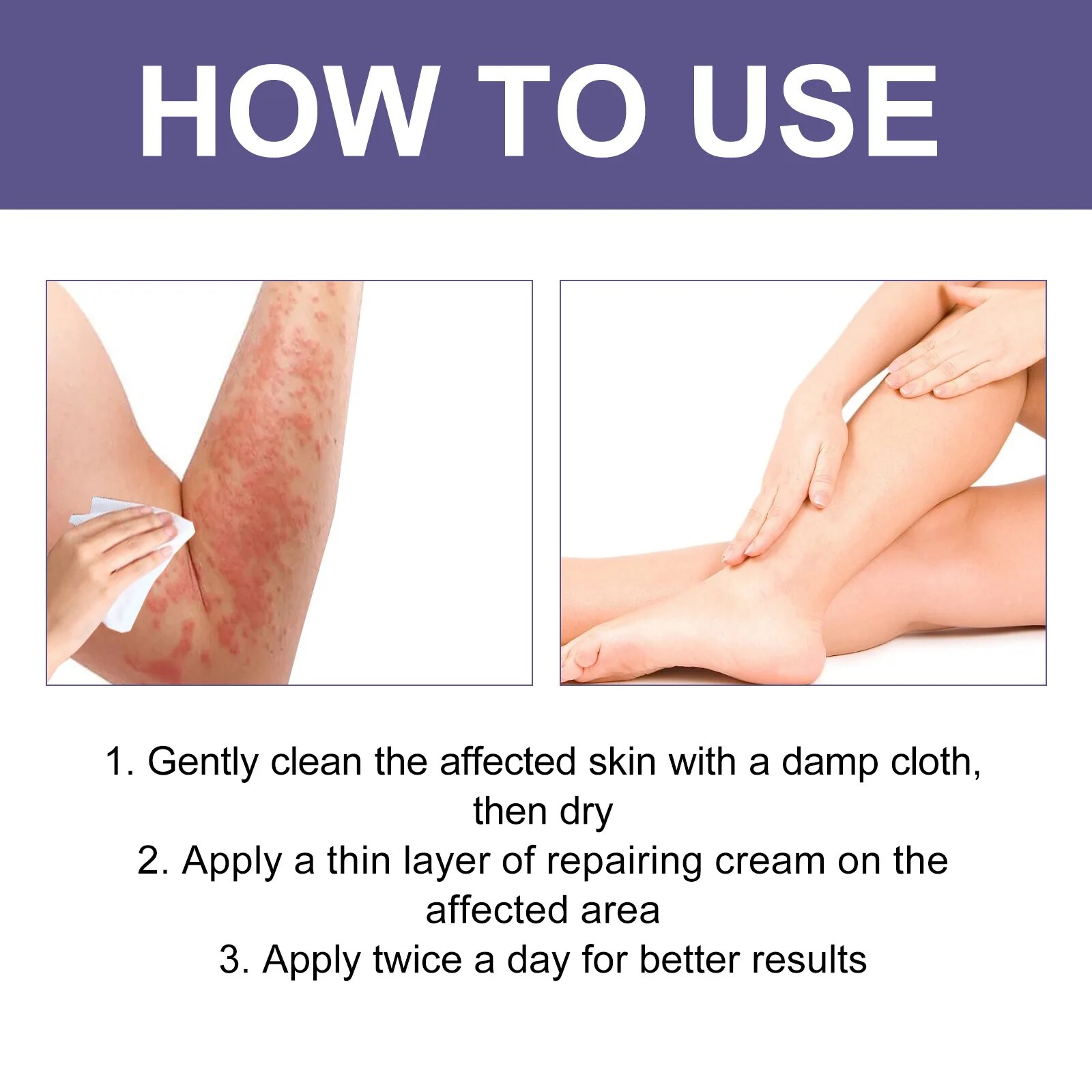 Eczema Treatment Cream Dermatitis Anti Itching Inhibit Fungi Urticaria ...
