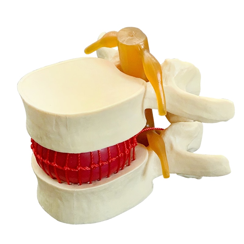 Medical body Lumbar disc herniation Demo model spine model | Daraz.lk