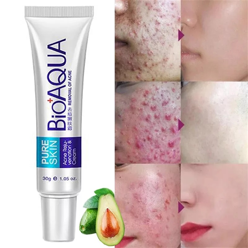 Bioaqua Pure Skin Face Care Acne Treatment Scar Removal Cream Stretch Marks Pimples Blackheads Daraz.lk