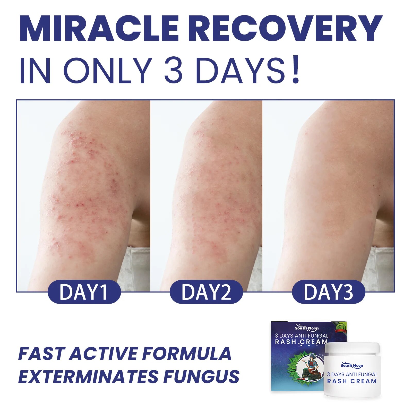 Eczema Treatment Cream Dermatitis Anti Itching Inhibit Fungi Urticaria ...