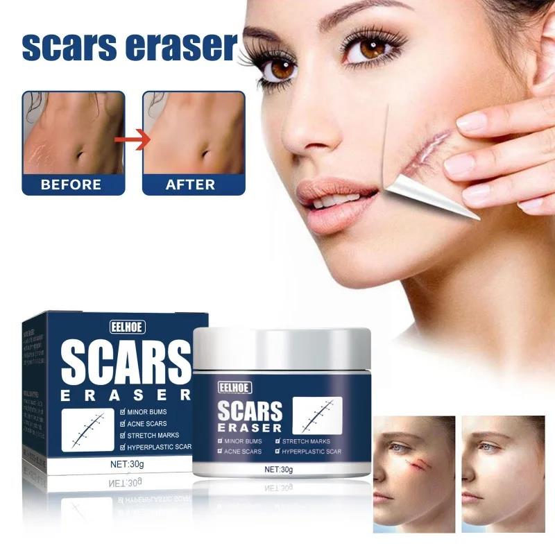 Fade Scar Cream Removal Burn Scald Stretch Marks Surgical scars Cold ...