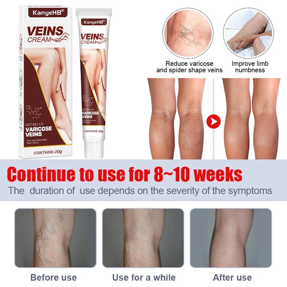 20g Relaxing Leg Cream Eliminate Vasculitis Phlebitis Spider Vein Care ...