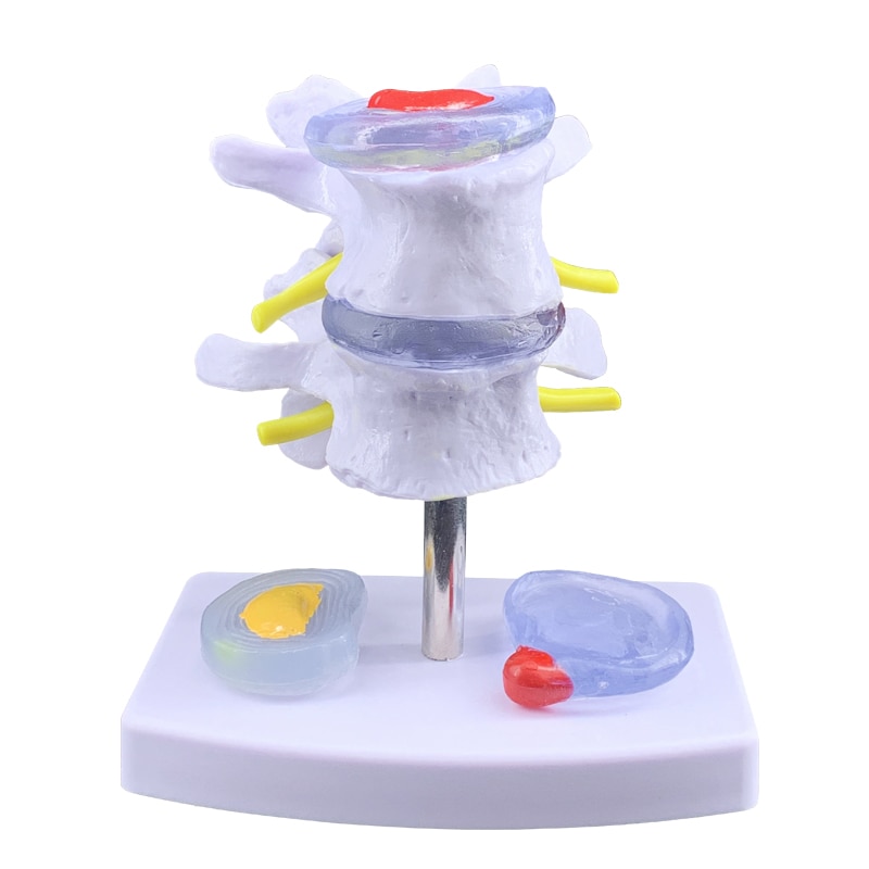 Medical body Lumbar disc herniation Demo model spine model | Daraz.lk